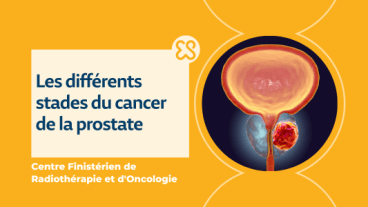 Cancer de la prostate stade 2, 3, 4 : Diagnostic et traitement, espérance de vie